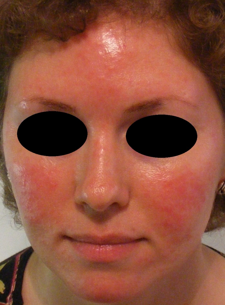 rozacee eritem - Dermestet